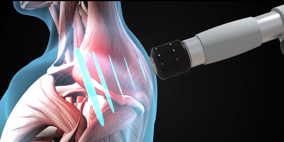 ESWT & RSWT Shockwave Therapy - Korehab Clinic - Orthopedic Surgery ...